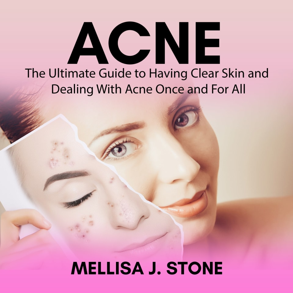 Acne: The Ultimate Guide to Having Clear Skin and Dealing With Acne ...
